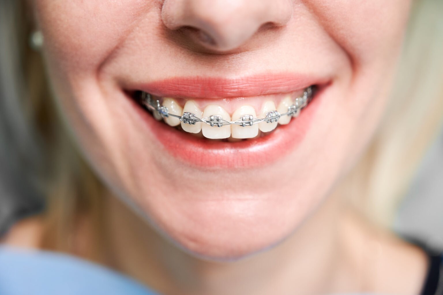 Self-Ligating Braces at Dentalane | Efficient Orthodontic Solution